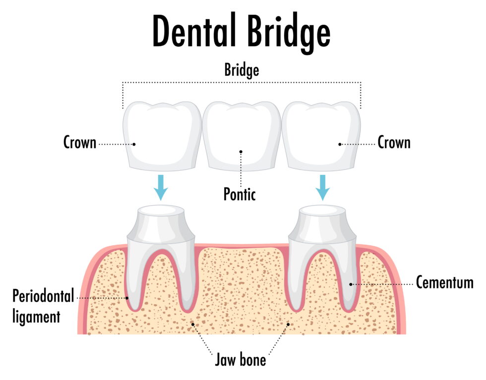 Dental Bridges: A Comprehensive Guide To The Different Types