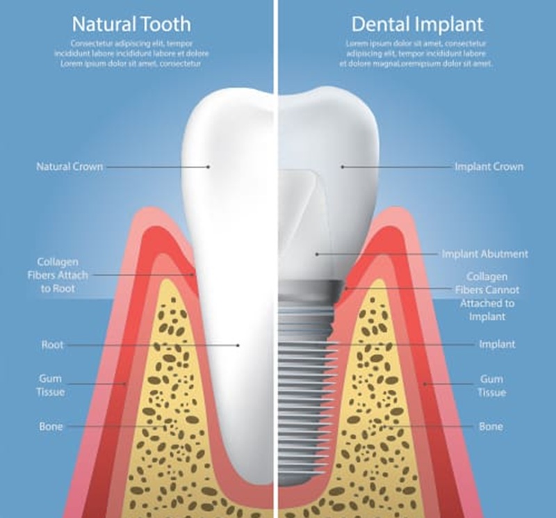 Dental Implants and All-On-Four | Pain Free Dental Clinic