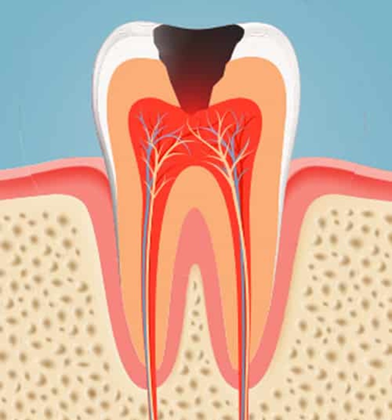 Root Canal Moss Vale | Pain Free Dental Clinic